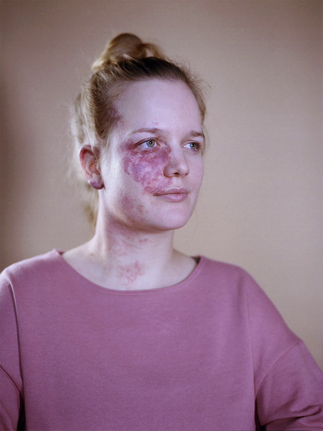 naevus flammeus-Mama hat ins Feuer geschaut – HEIDE PRANGE