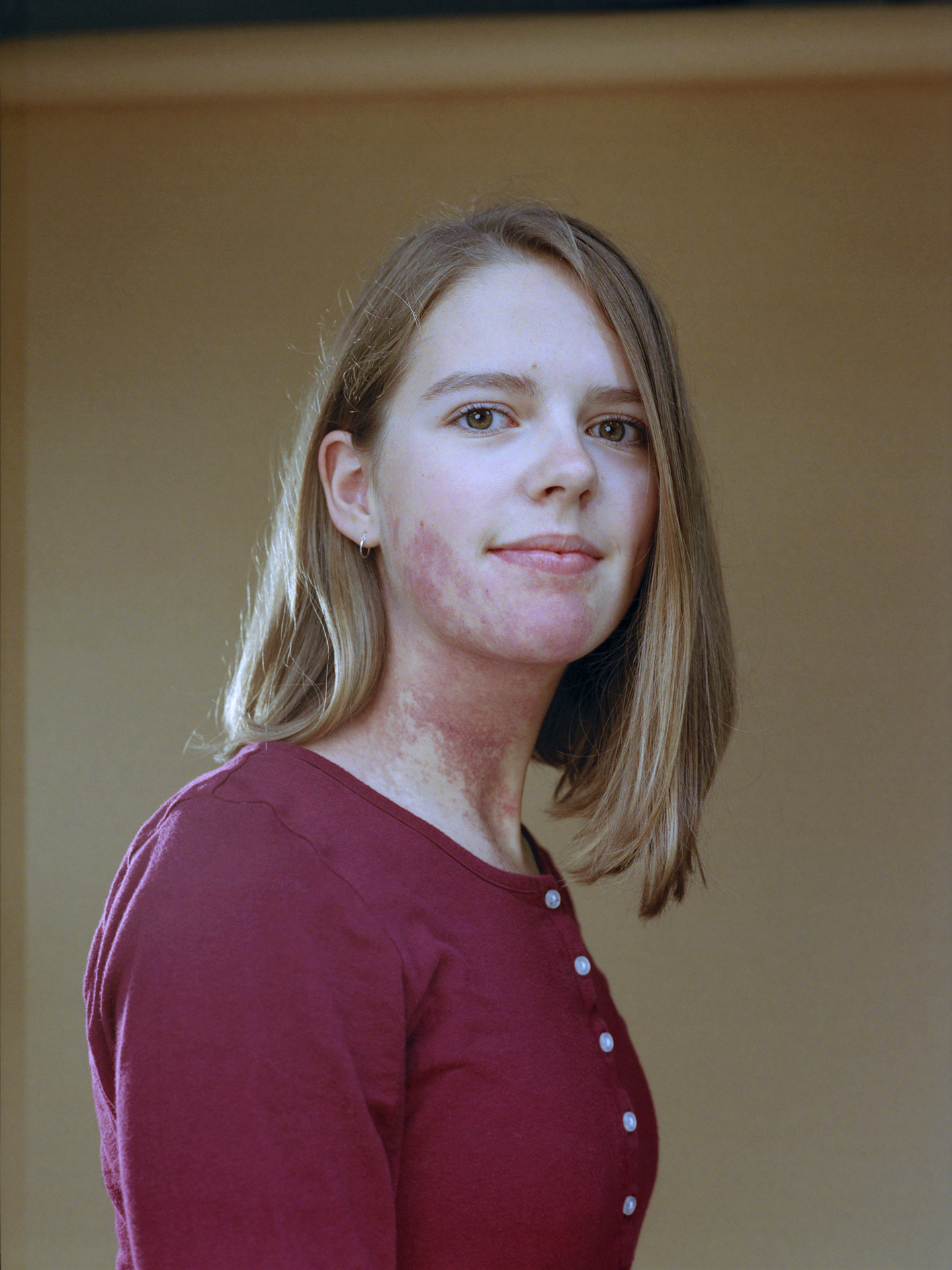 naevus flammeus-Mama hat ins Feuer geschaut – HEIDE PRANGE