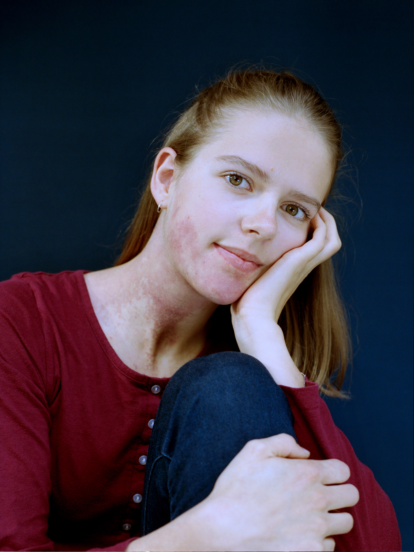 naevus flammeus-Mama hat ins Feuer geschaut – HEIDE PRANGE