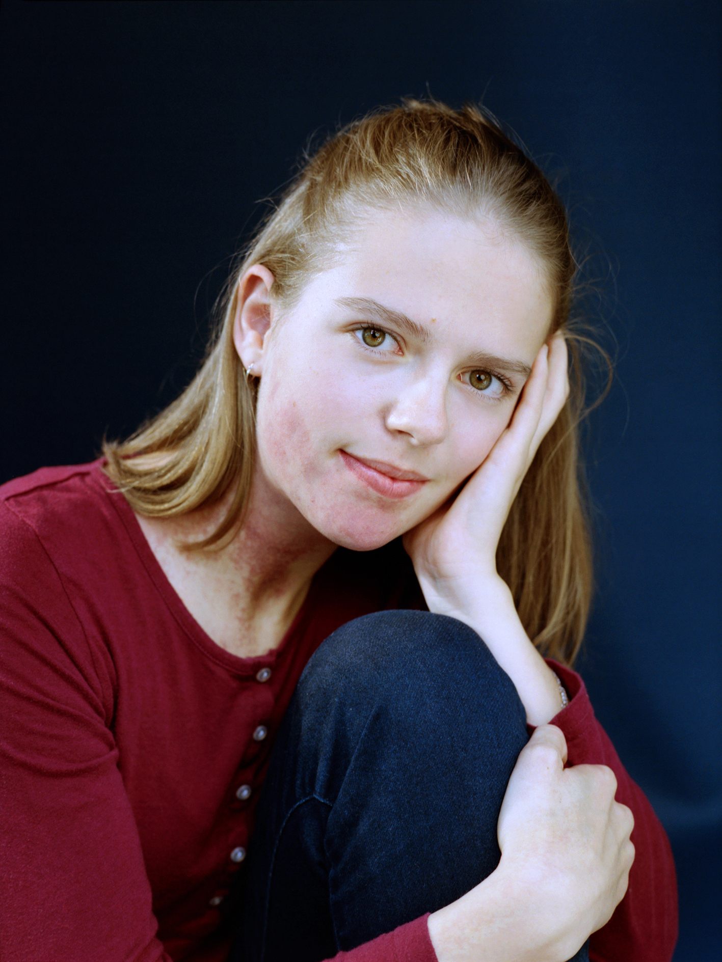 naevus flammeus-Mama hat ins Feuer geschaut – HEIDE PRANGE