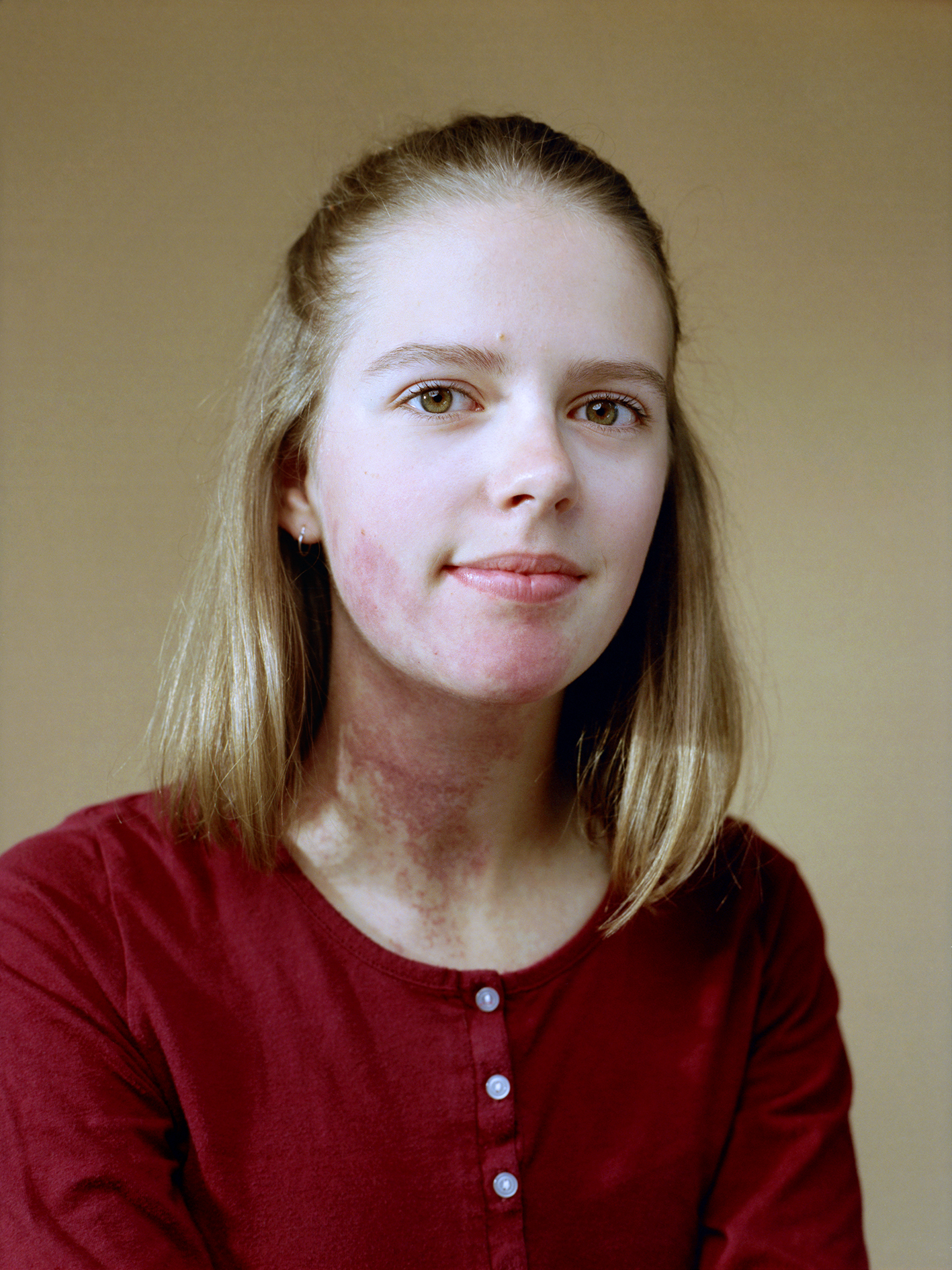 naevus flammeus-Mama hat ins Feuer geschaut – HEIDE PRANGE