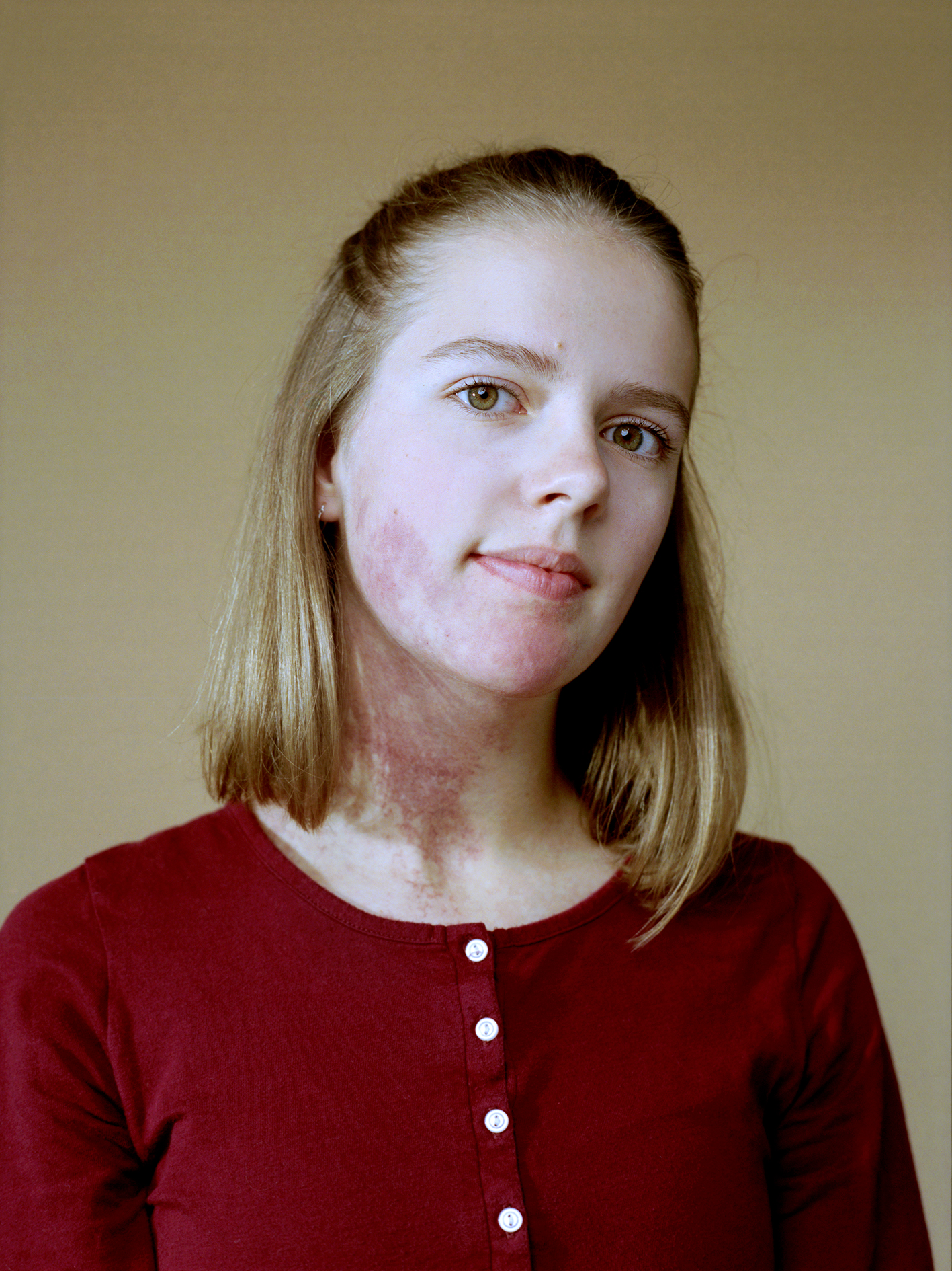 naevus flammeus-Mama hat ins Feuer geschaut – HEIDE PRANGE